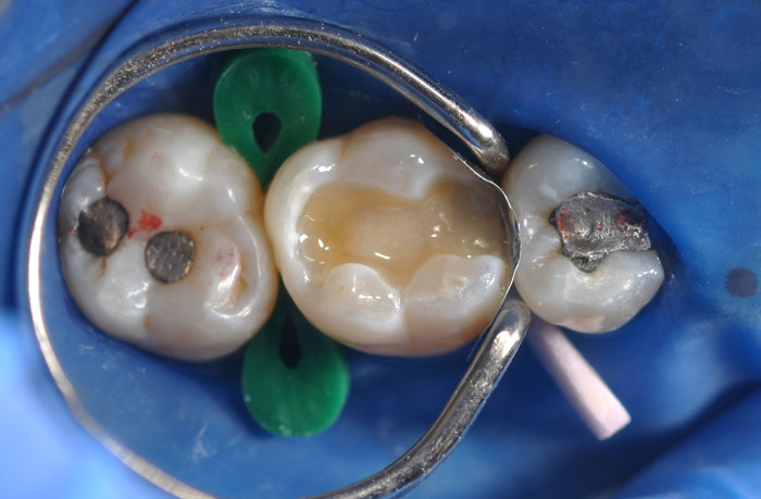 Unimatrix Rings - Preformed sectional matrix system for class II resto